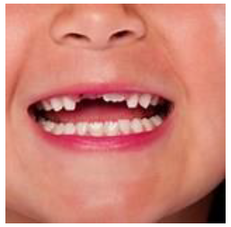 Information for people who care for a child who is having teeth out ...